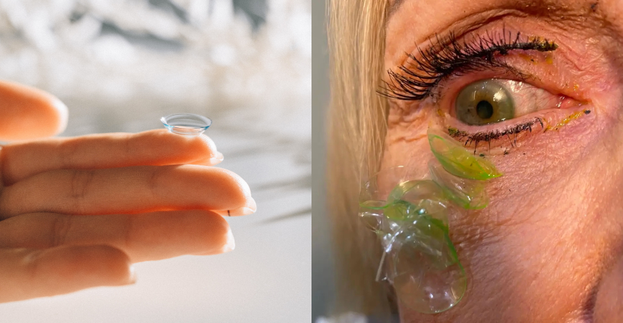 A woman had 23 contact lenses removed from her eye - here's what happened