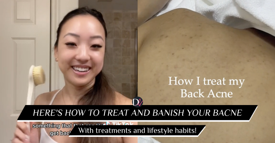 8 habits that causes bacne and how you can treat them