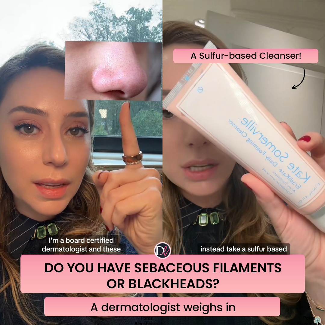 What You See on Your Nose Aren’t Blackheads. Dermatologist Shares What It Is and How to Treat It