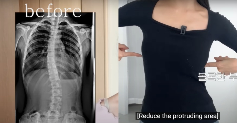 This Korean YouTuber Corrected Her Facial Asymmetry and Poor Posture ...